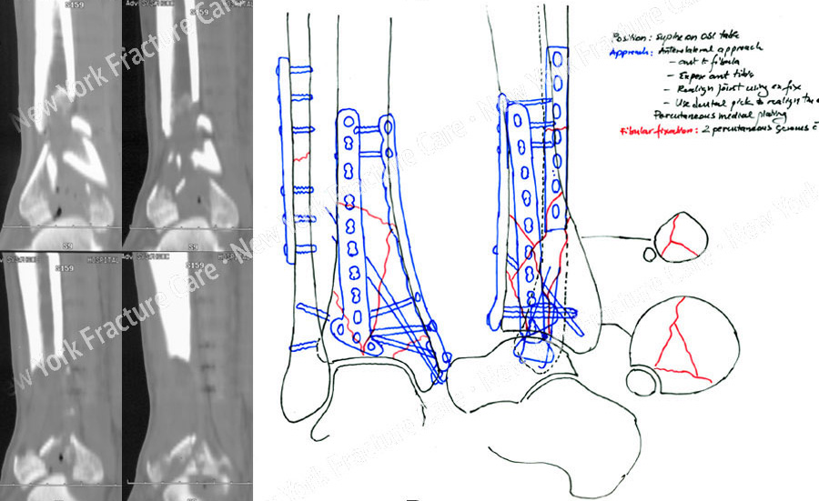 Distal Tibia pilon Fractures New York Fracture Care Distal Tibia pilon Fractures New York Fracture Care